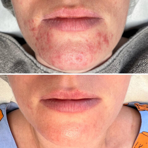 Perioral dermatitis behandling » Få lindring af symptomer