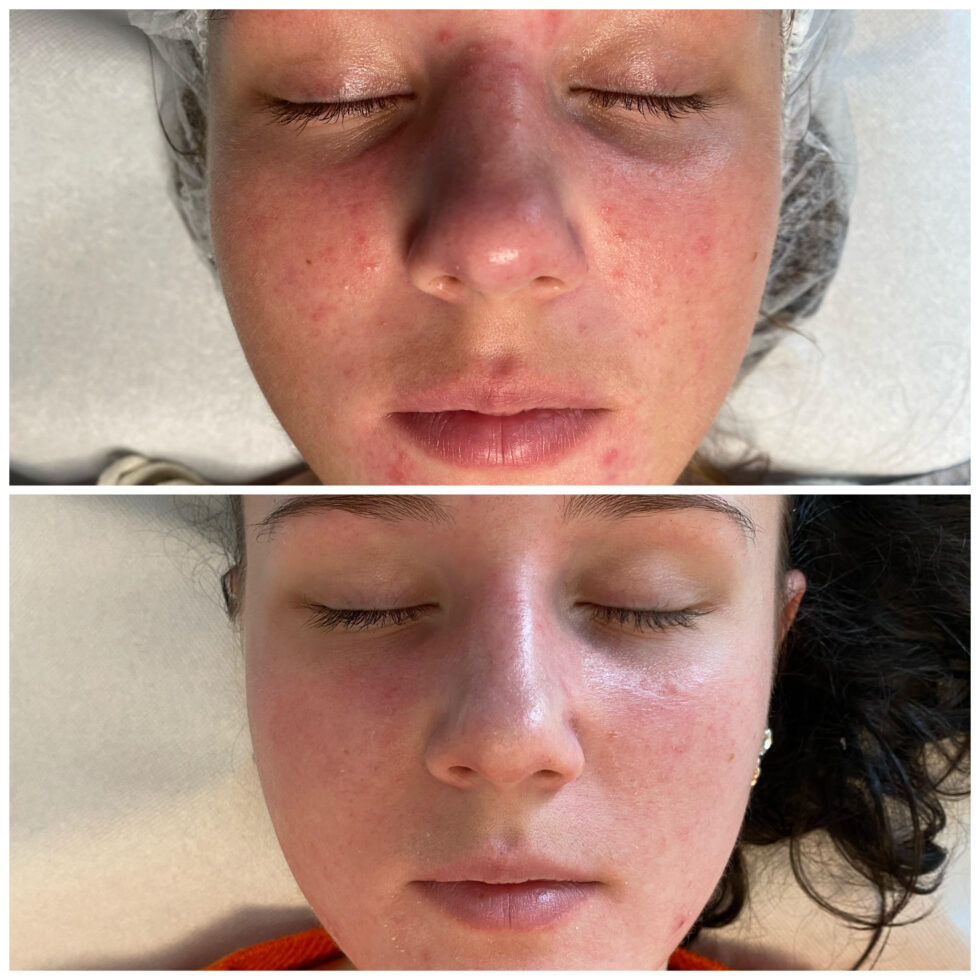 Rosacea Behandling | Hudplejeklinik i Vejle | Borch & Selmer